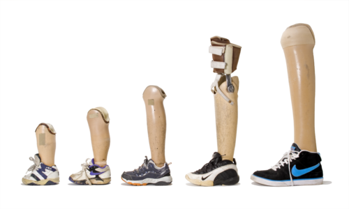 Artificial Limb Nagpur – Prosthetics Blog