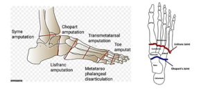 Syme Amputation: A Comprehensive Guide – Prosthetics Blog